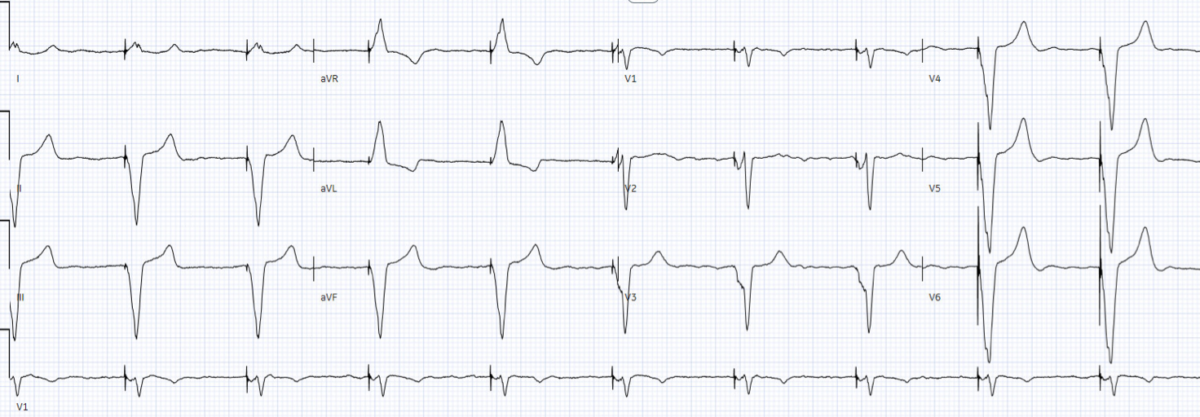 PACER mnemonic approach to pacemaker patients | ECG Cases | EM Cases