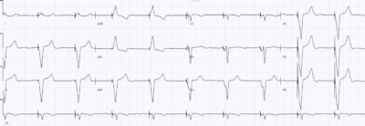 PACER mnemonic approach to pacemaker patients | ECG Cases | EM Cases