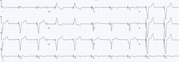 PACER mnemonic approach to pacemaker patients | ECG Cases | EM Cases