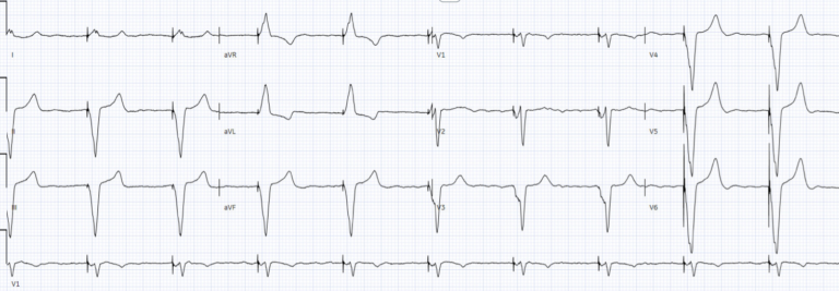 PACER mnemonic approach to pacemaker patients | ECG Cases | EM Cases