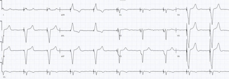 PACER mnemonic approach to pacemaker patients | ECG Cases | EM Cases