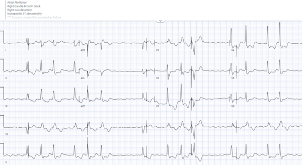 PACER mnemonic approach to pacemaker patients | ECG Cases | EM Cases