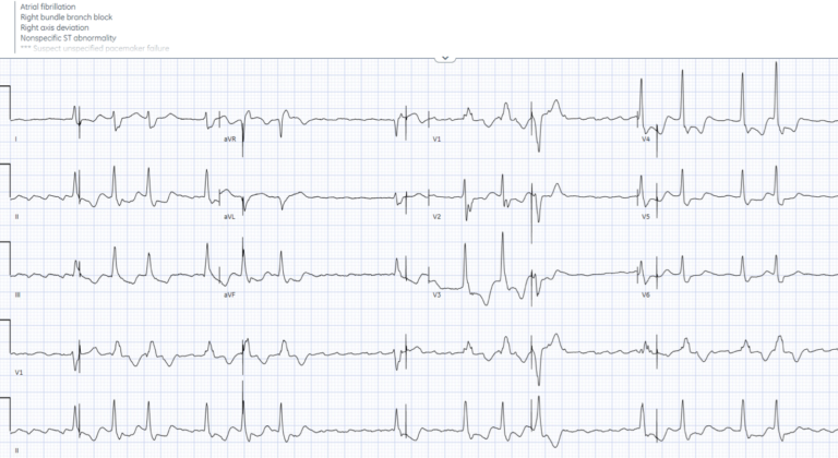 PACER mnemonic approach to pacemaker patients | ECG Cases | EM Cases