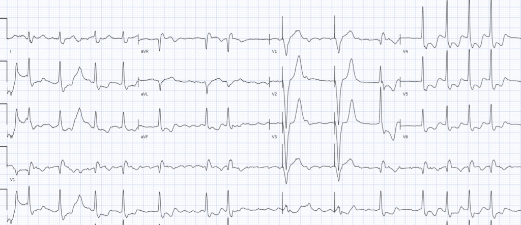 PACER mnemonic approach to pacemaker patients | ECG Cases | EM Cases