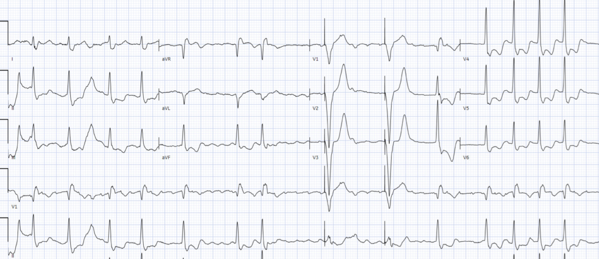 PACER mnemonic approach to pacemaker patients | ECG Cases | EM Cases