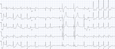 PACER mnemonic approach to pacemaker patients | ECG Cases | EM Cases