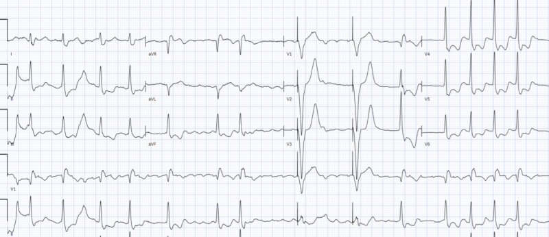 PACER mnemonic approach to pacemaker patients | ECG Cases | EM Cases
