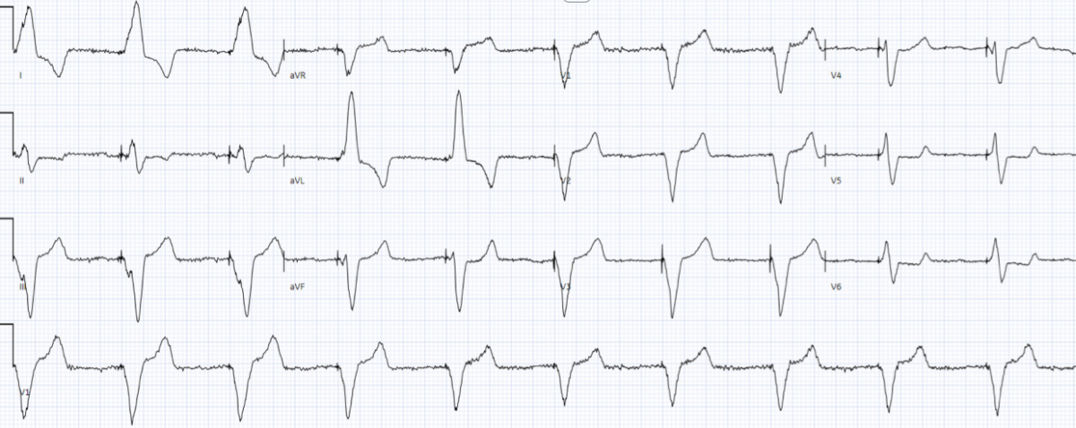 PACER mnemonic approach to pacemaker patients | ECG Cases | EM Cases