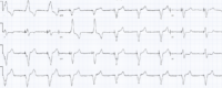 PACER mnemonic approach to pacemaker patients | ECG Cases | EM Cases