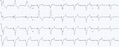 PACER mnemonic approach to pacemaker patients | ECG Cases | EM Cases