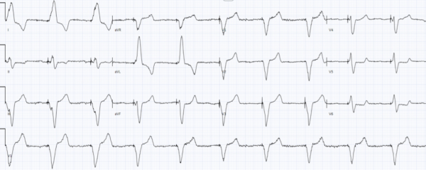 PACER mnemonic approach to pacemaker patients | ECG Cases | EM Cases