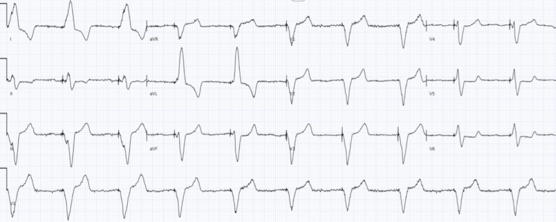 PACER mnemonic approach to pacemaker patients | ECG Cases | EM Cases
