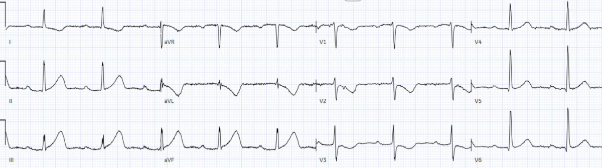 PACER mnemonic approach to pacemaker patients | ECG Cases | EM Cases