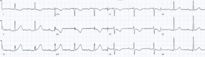 PACER mnemonic approach to pacemaker patients | ECG Cases | EM Cases