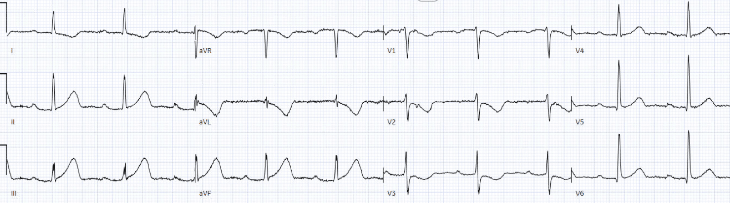 PACER mnemonic approach to pacemaker patients | ECG Cases | EM Cases