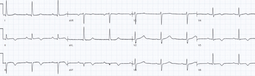 PACER mnemonic approach to pacemaker patients | ECG Cases | EM Cases