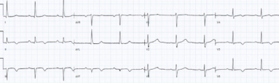 PACER mnemonic approach to pacemaker patients | ECG Cases | EM Cases