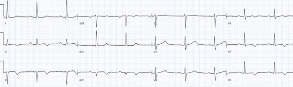 PACER mnemonic approach to pacemaker patients | ECG Cases | EM Cases