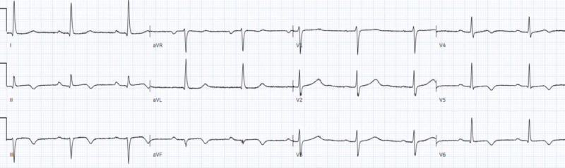 PACER mnemonic approach to pacemaker patients | ECG Cases | EM Cases