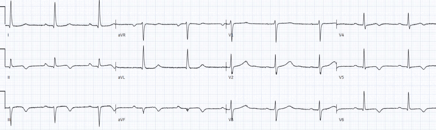 PACER mnemonic approach to pacemaker patients | ECG Cases | EM Cases
