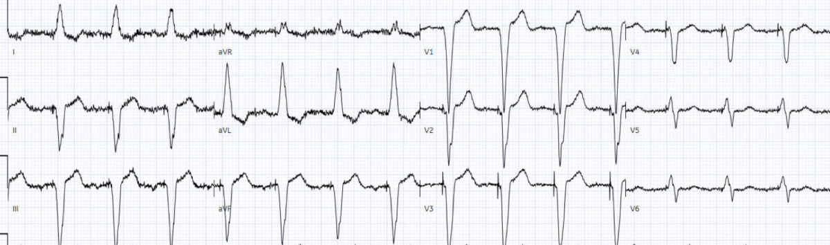PACER mnemonic approach to pacemaker patients | ECG Cases | EM Cases