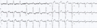 PACER mnemonic approach to pacemaker patients | ECG Cases | EM Cases