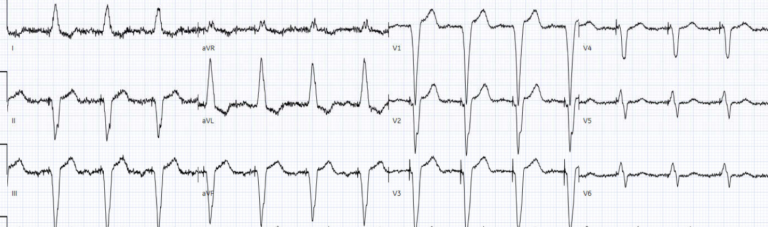 PACER mnemonic approach to pacemaker patients | ECG Cases | EM Cases
