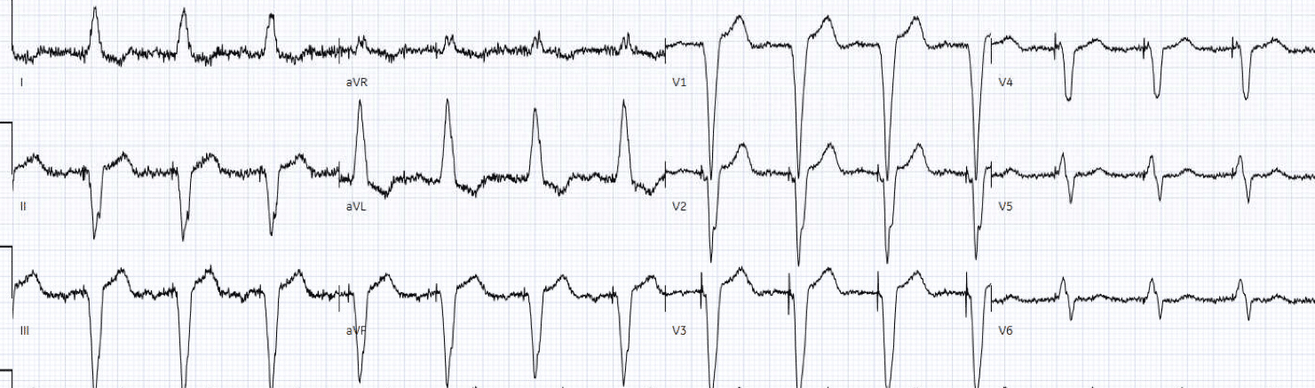 PACER mnemonic approach to pacemaker patients | ECG Cases | EM Cases