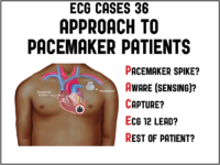 PACER mnemonic approach to pacemaker patients | ECG Cases | EM Cases