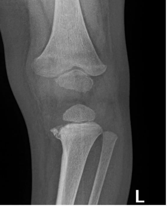 Emergency Orthopedics Differential Diagnosis - SCARED OF mnemonic | EM ...
