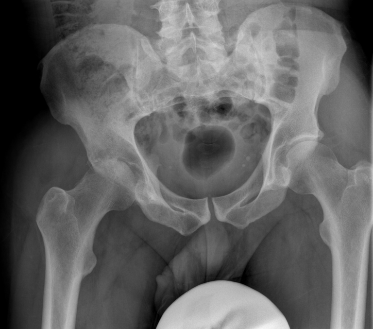 Emergency Orthopedics Differential Diagnosis - SCARED OF mnemonic | EM ...