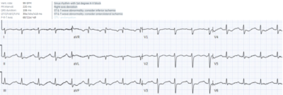 ECG interpretation in electrolyte emergencies | ECG Cases | EM Cases