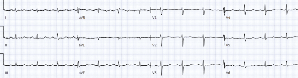 ECG interpretation in electrolyte emergencies | ECG Cases | EM Cases