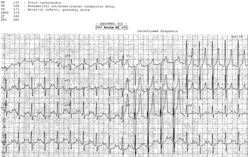 ECG interpretation in electrolyte emergencies | ECG Cases | EM Cases