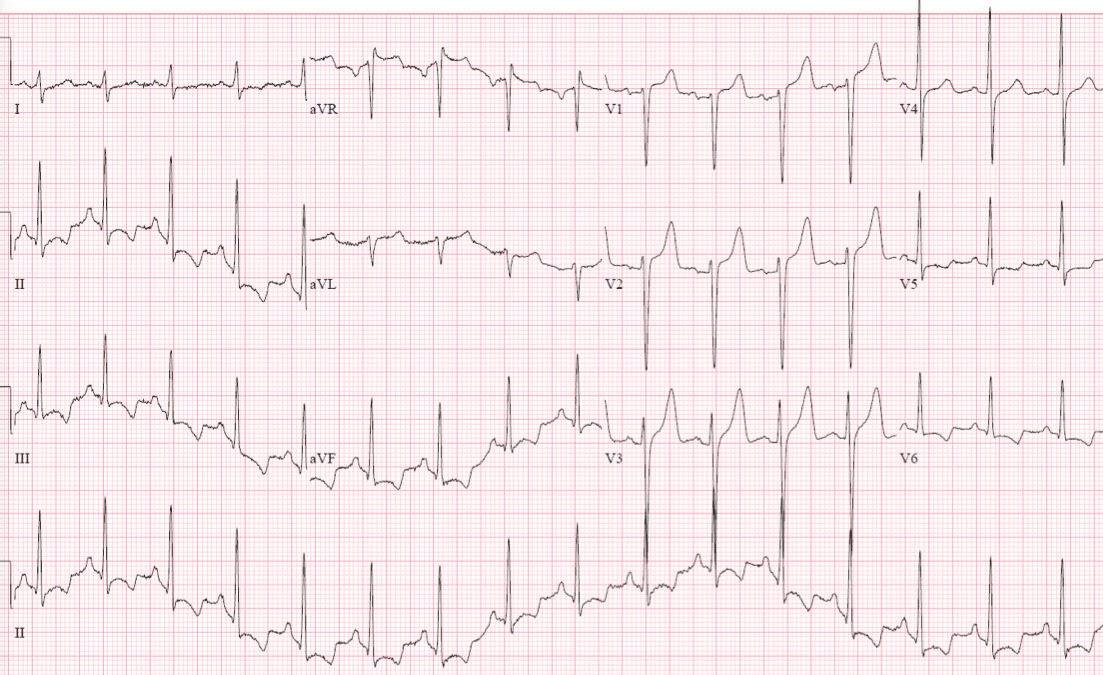 ECG interpretation in electrolyte emergencies | ECG Cases | EM Cases