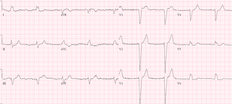 ECG interpretation in electrolyte emergencies | ECG Cases | EM Cases