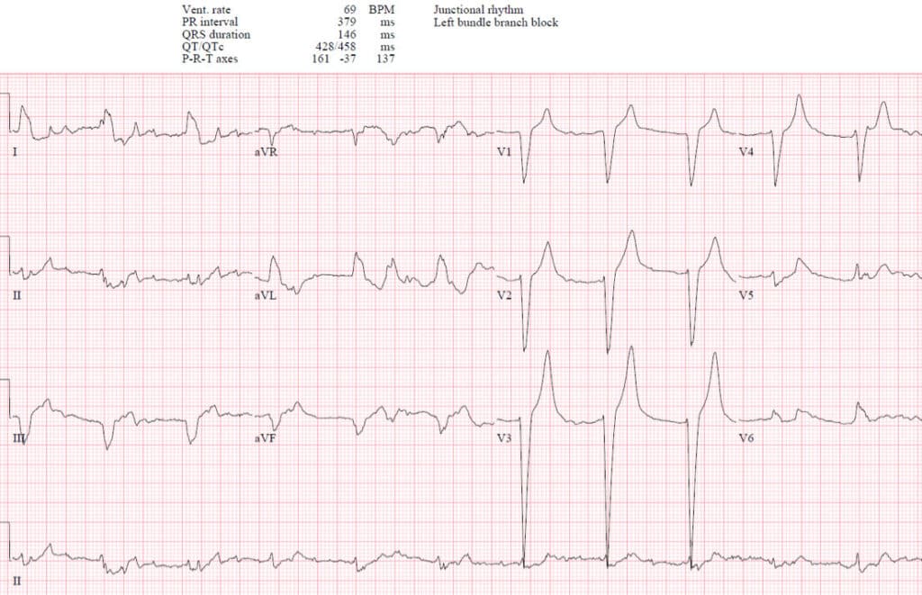 ECG interpretation in electrolyte emergencies | ECG Cases | EM Cases