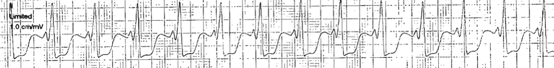 ECG interpretation in electrolyte emergencies | ECG Cases | EM Cases
