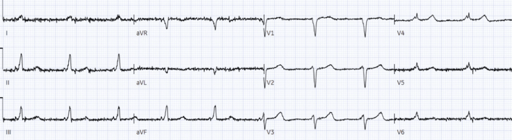 ECG interpretation in electrolyte emergencies | ECG Cases | EM Cases