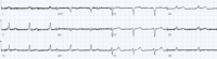 ECG interpretation in electrolyte emergencies | ECG Cases | EM Cases