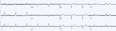 ECG interpretation in electrolyte emergencies | ECG Cases | EM Cases
