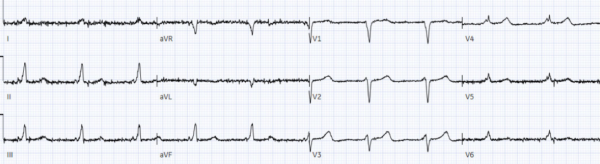 ECG interpretation in electrolyte emergencies | ECG Cases | EM Cases
