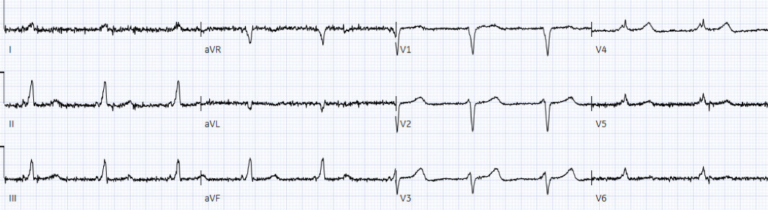 ECG interpretation in electrolyte emergencies | ECG Cases | EM Cases