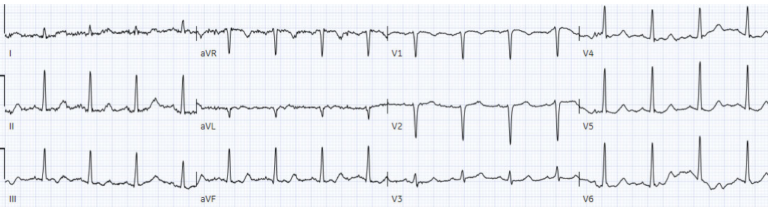 ECG interpretation in electrolyte emergencies | ECG Cases | EM Cases