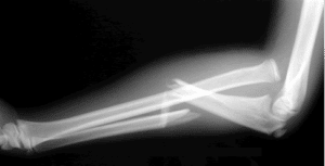 Orthopedic X-rays Masterclass | Emergency Medicine Cases