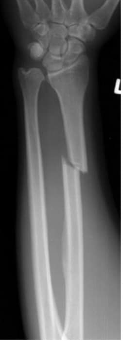 Orthopedic X-rays Masterclass | Emergency Medicine Cases