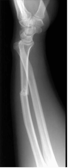 Orthopedic X-rays Masterclass | Emergency Medicine Cases