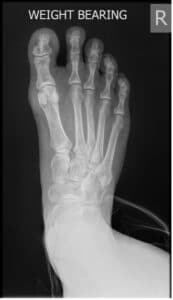 Orthopedic X-rays Masterclass | Emergency Medicine Cases