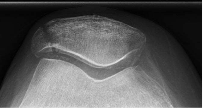 Orthopedic X-rays Masterclass | Emergency Medicine Cases