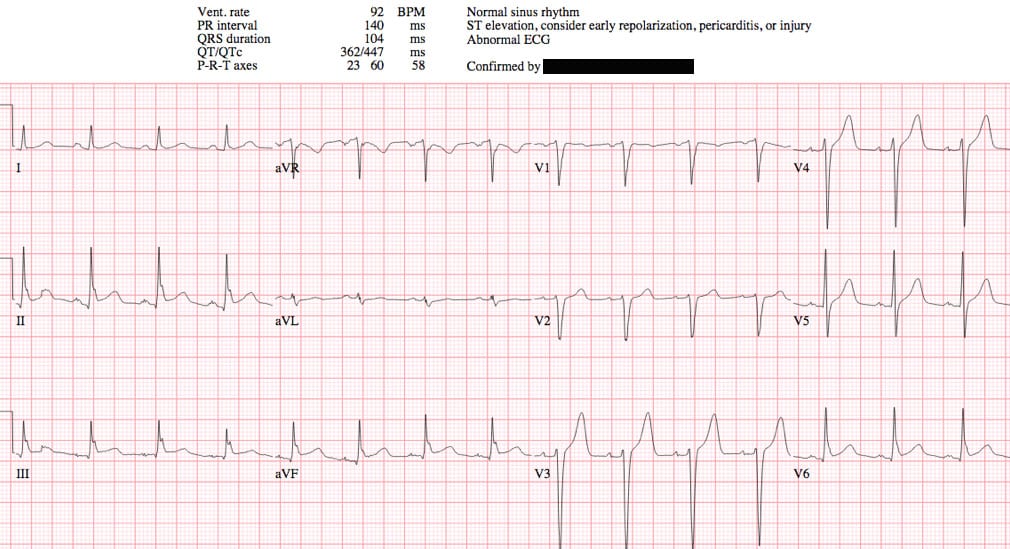 ECG Interpretation in Cocaine Chest Pain - האיגוד הישראלי לרפואה דחופה